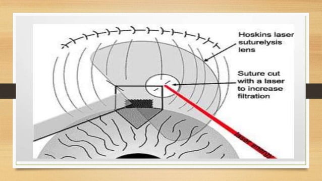 Trabeculectomy surgical procedure | PPTX