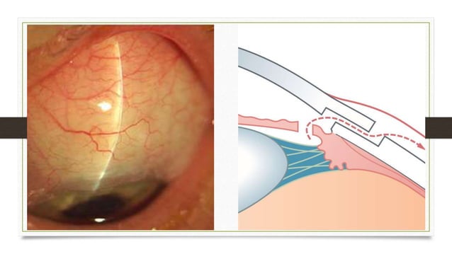 Trabeculectomy surgical procedure | PPTX