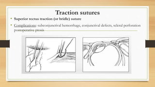 Trabeculectomy surgical procedure | PPT