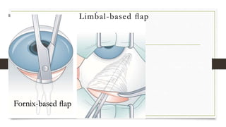 Trabeculectomy surgical procedure | PPT