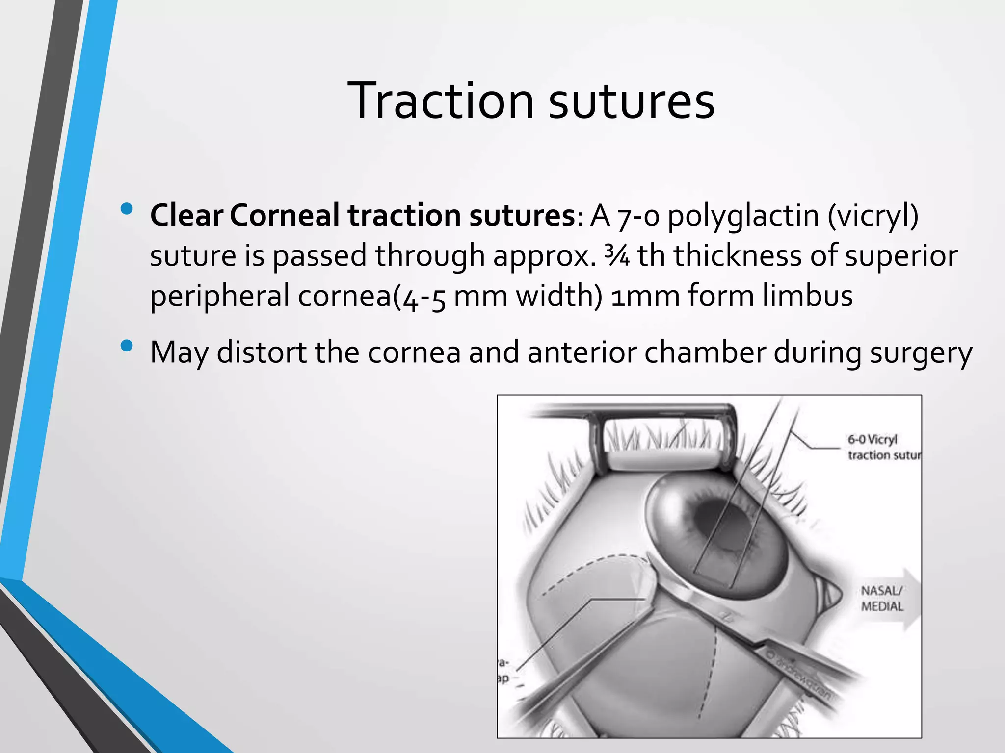 Trabeculectomy, trabeculotomy, goniotomy and their complications | PPTX