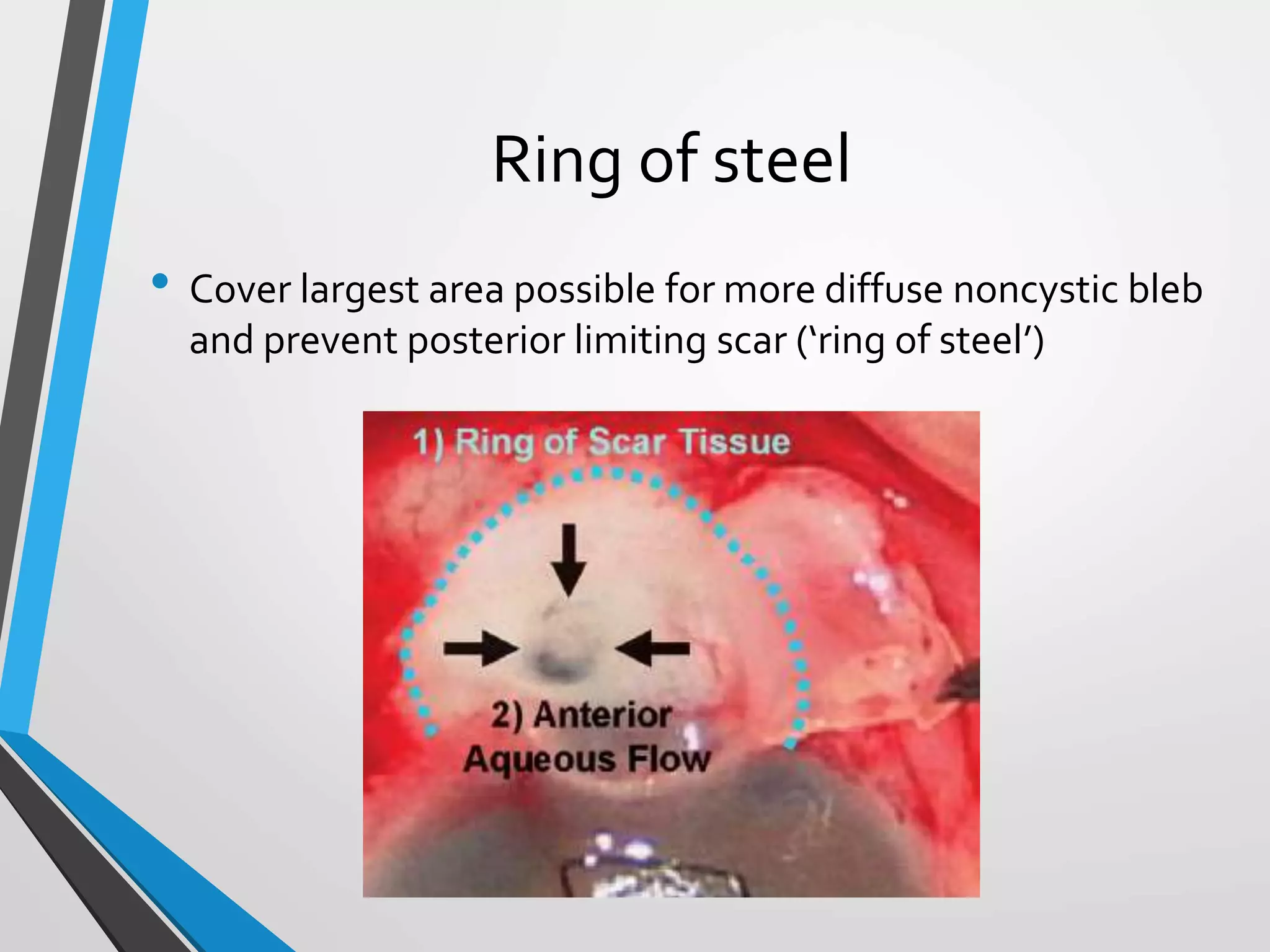 Trabeculectomy, trabeculotomy, goniotomy and their complications | PPTX