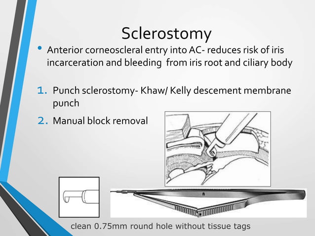 Trabeculectomy, trabeculotomy, goniotomy and their complications | PPTX ...