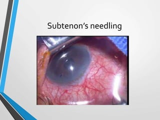 Trabeculectomy, trabeculotomy, goniotomy and their complications | PPTX