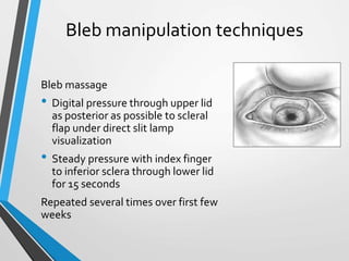 Trabeculectomy, trabeculotomy, goniotomy and their complications | PPTX