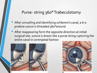 Trabeculectomy, trabeculotomy, goniotomy and their complications | PPTX