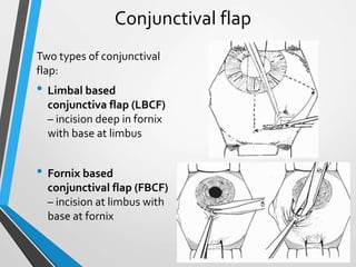 Trabeculectomy, trabeculotomy, goniotomy and their complications | PPT