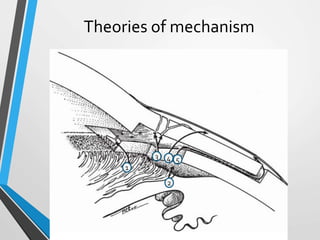 Trabeculectomy Diagram