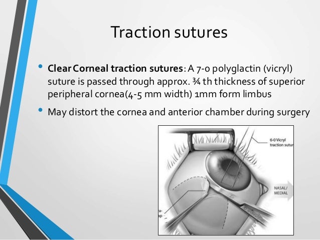 Trabeculectomy, trabeculotomy, goniotomy and their complications