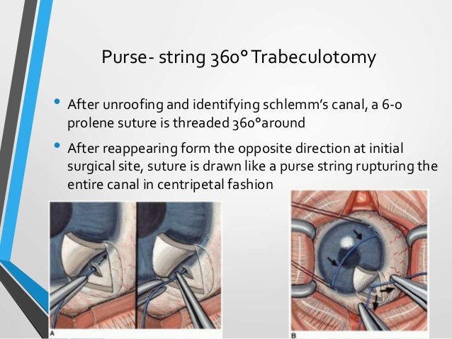 Trabeculectomy, trabeculotomy, goniotomy and their complications