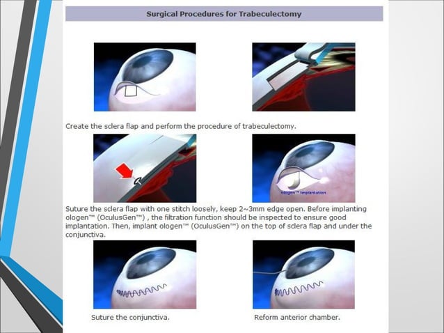 Glaucoma Filtration Surgery Study | PPT | Eye and Vision Conditions ...