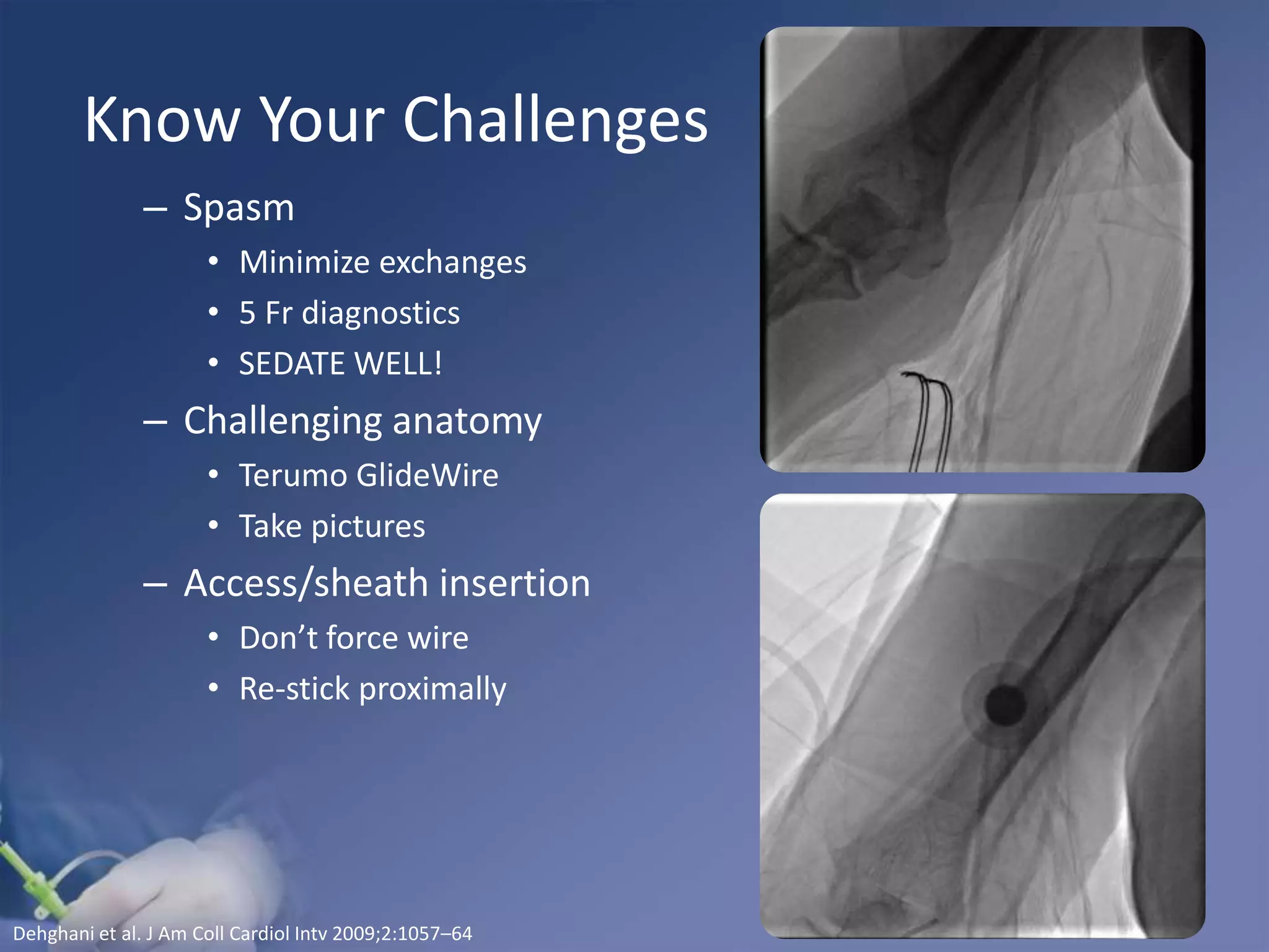 Transradial access and challenges edited 10 5-15 | PPTX | Medical Health