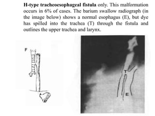 Trachea | PPTX