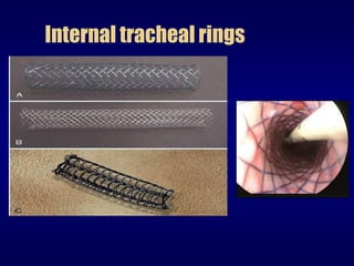 Trachea collapse | PDF