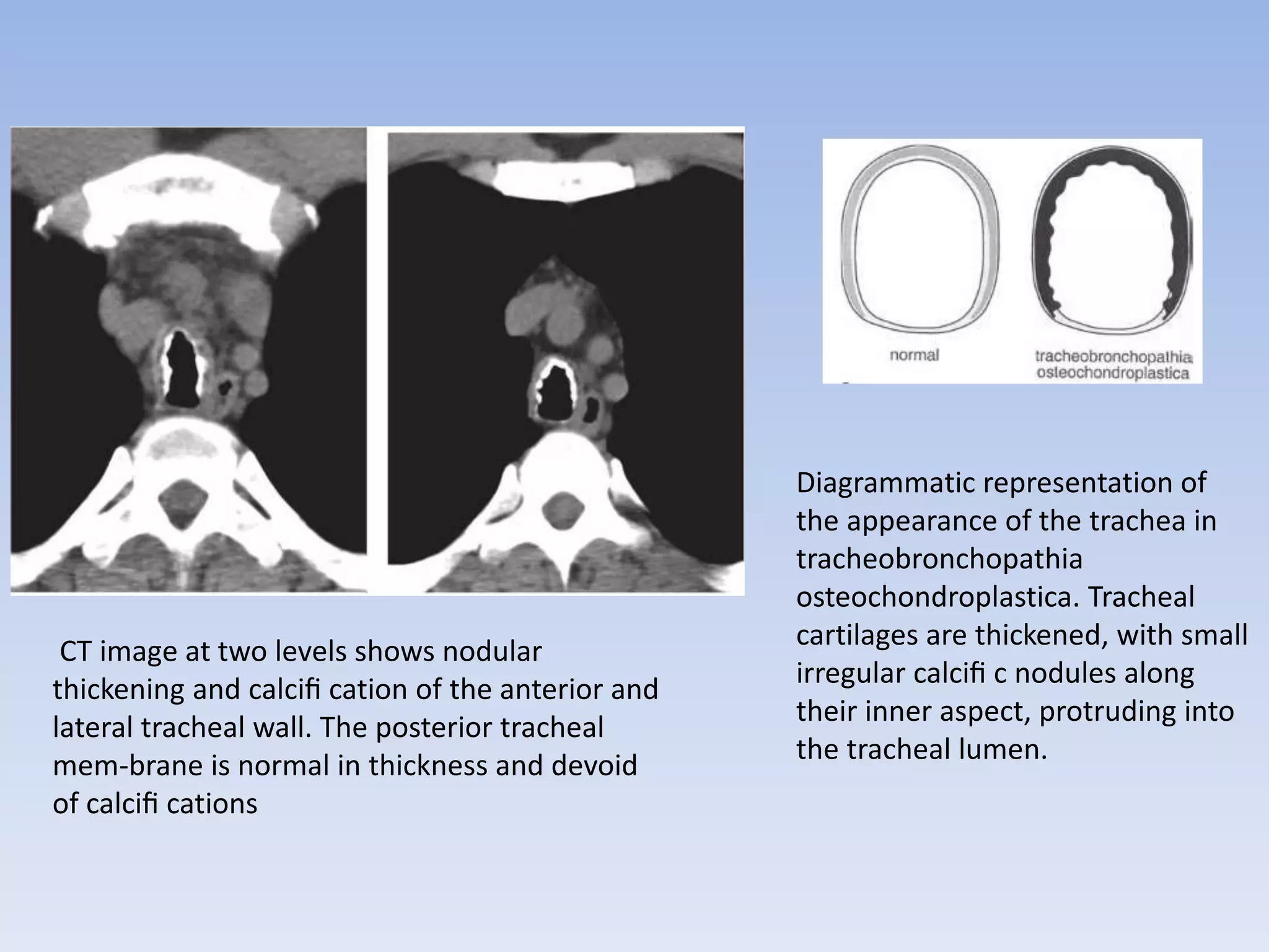 Tracheal pathologies | PPTX