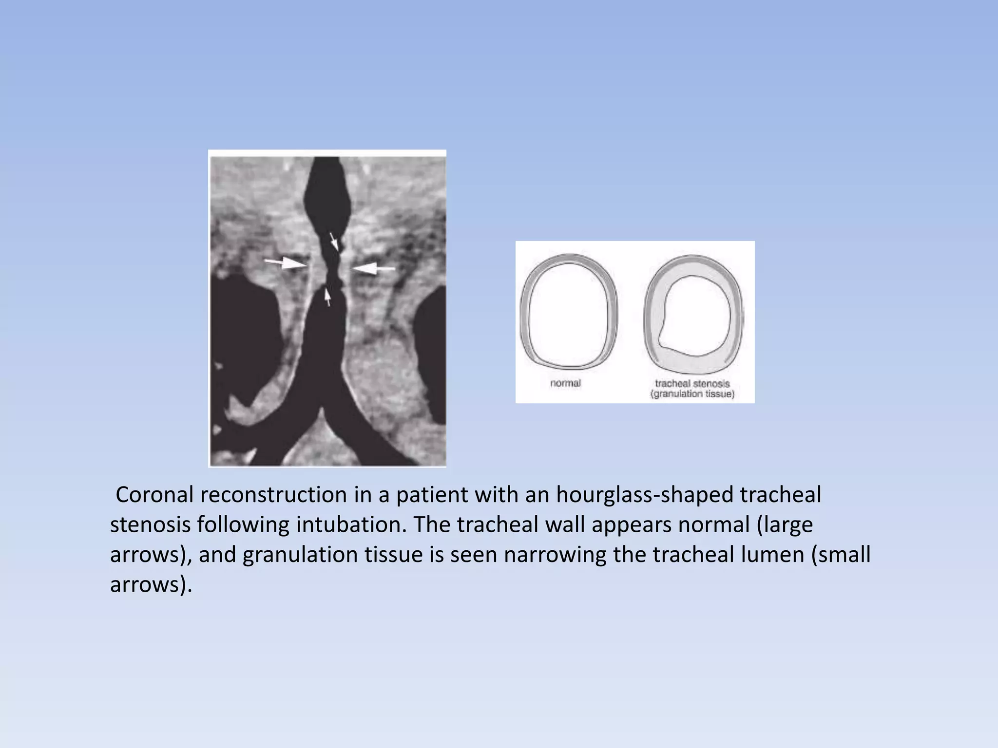 Tracheal pathologies | PPTX