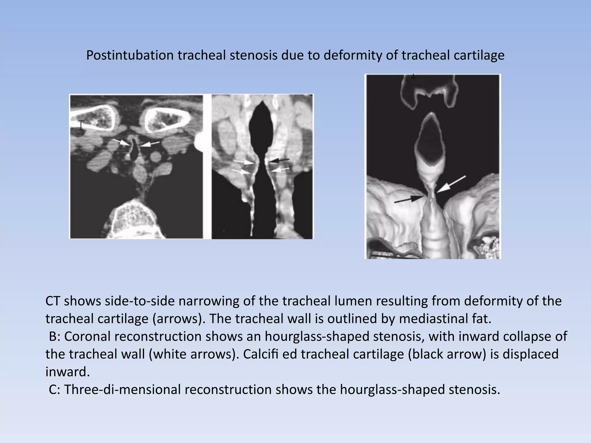 Tracheal pathologies | PPTX