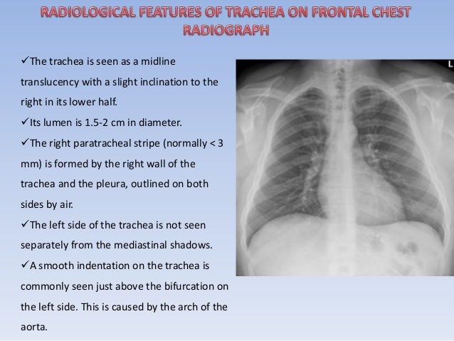 Tracheal pathologies