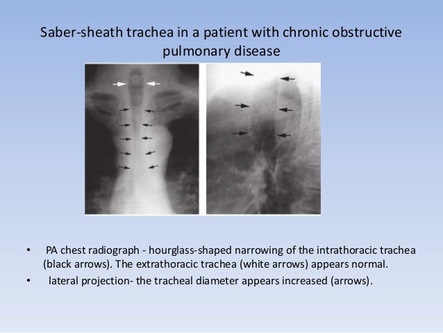 Tracheal pathologies