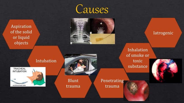 Tracheal injury & stenosis | PPTX