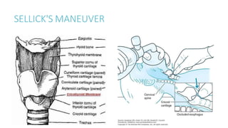 Tracheal sugeries | PPTX