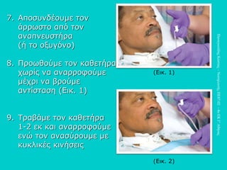 Αναρρόφηση τραχείας | PPTX