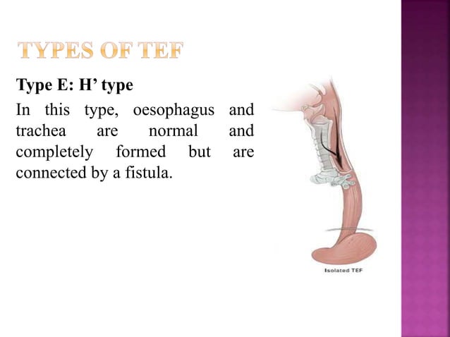 tracheo-oesophagealfistula | PPT
