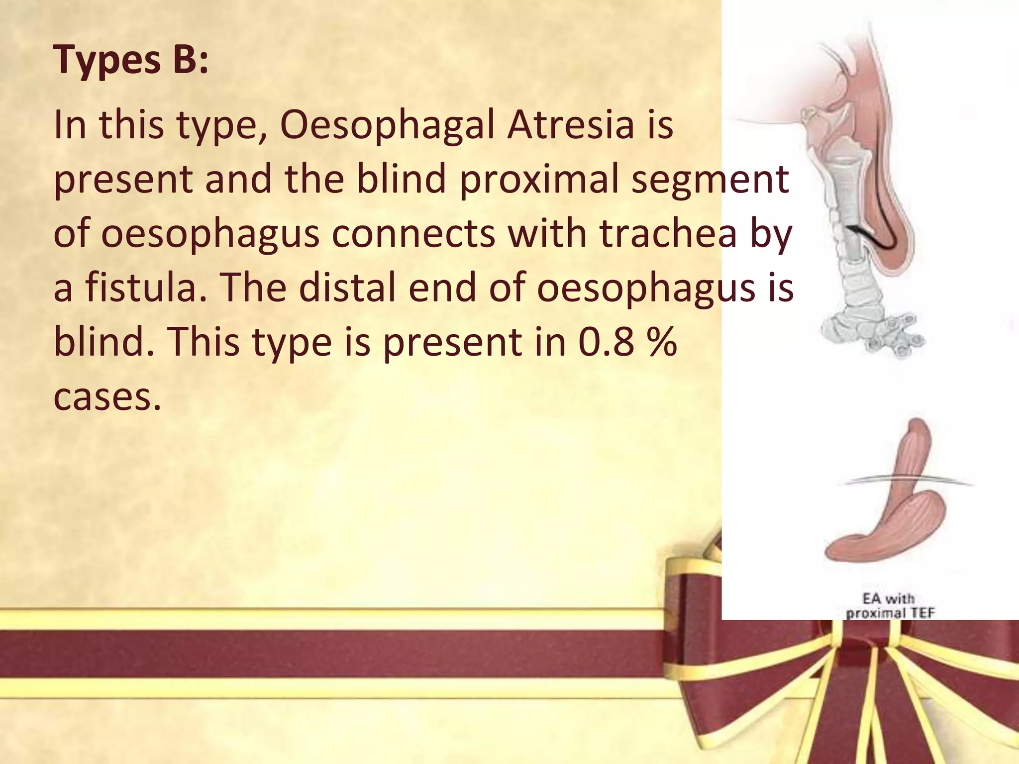 Tracheo oesophageal fistula | PPTX