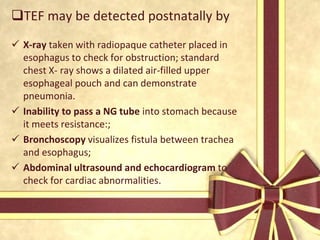 Tracheo oesophageal fistula | PPTX