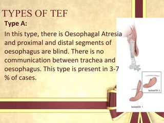 Tracheo oesophageal fistula | PPTX