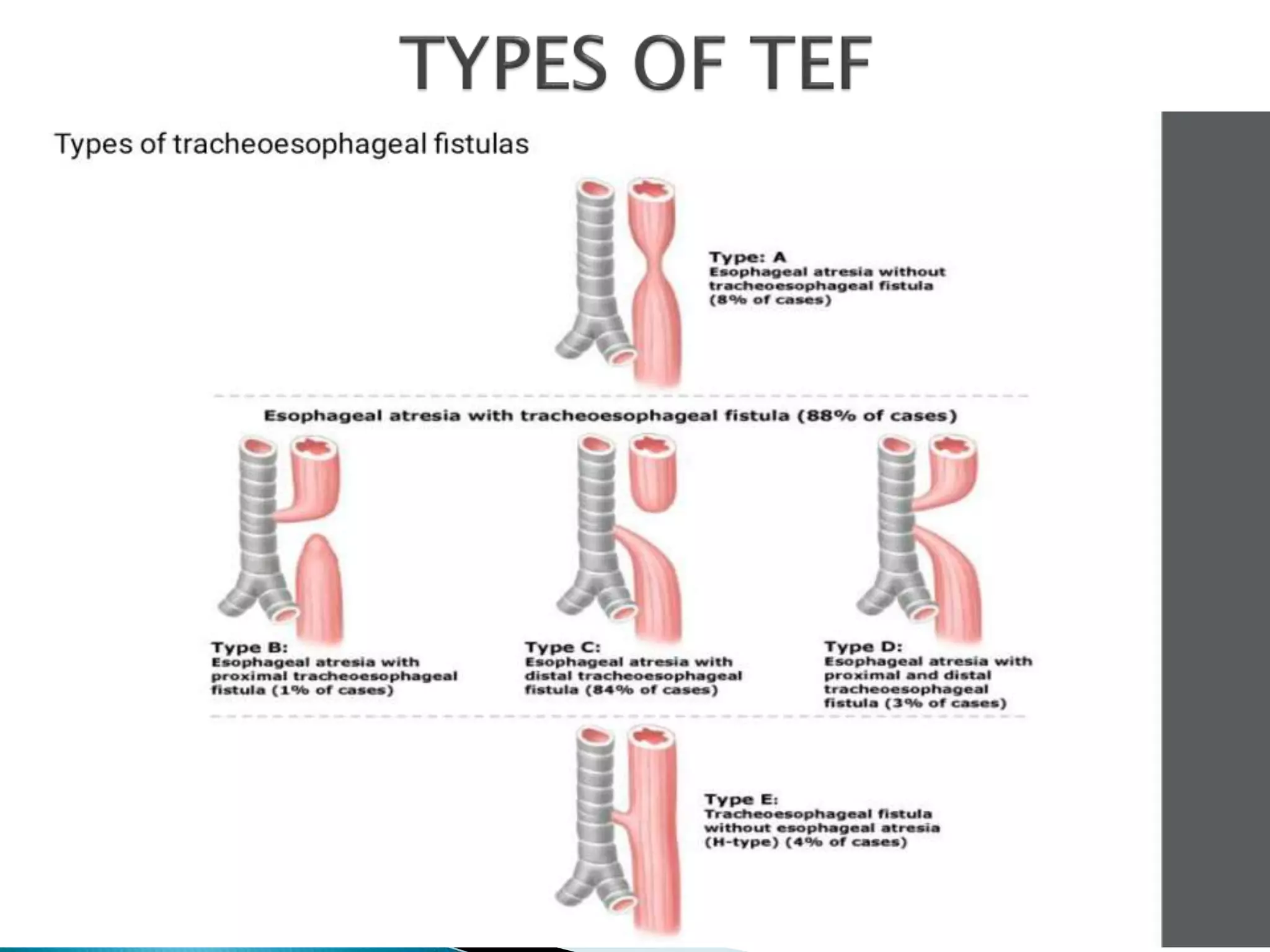 Tracheo oesophageal fistula | PPTX