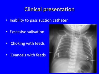 Anesthesia for Tracheoesophageal fistula | PPTX