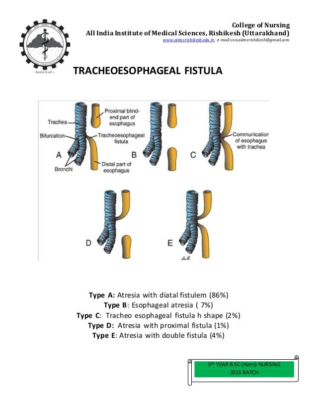 Tracheoesophageal Fistula H Type H Type Fistula Tracheoesophageal