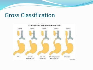 Tracheoesophageal Fistula Classification