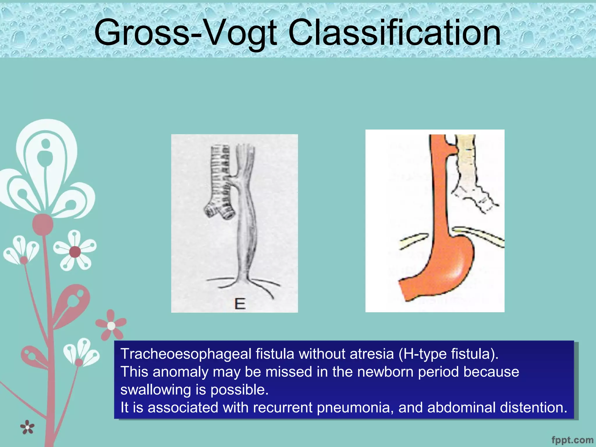 Tracheoesophageal fistula | PPT