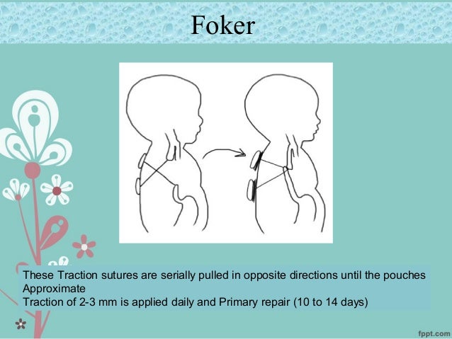 Tracheoesophageal fistula