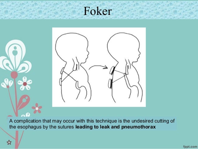 Tracheoesophageal fistula