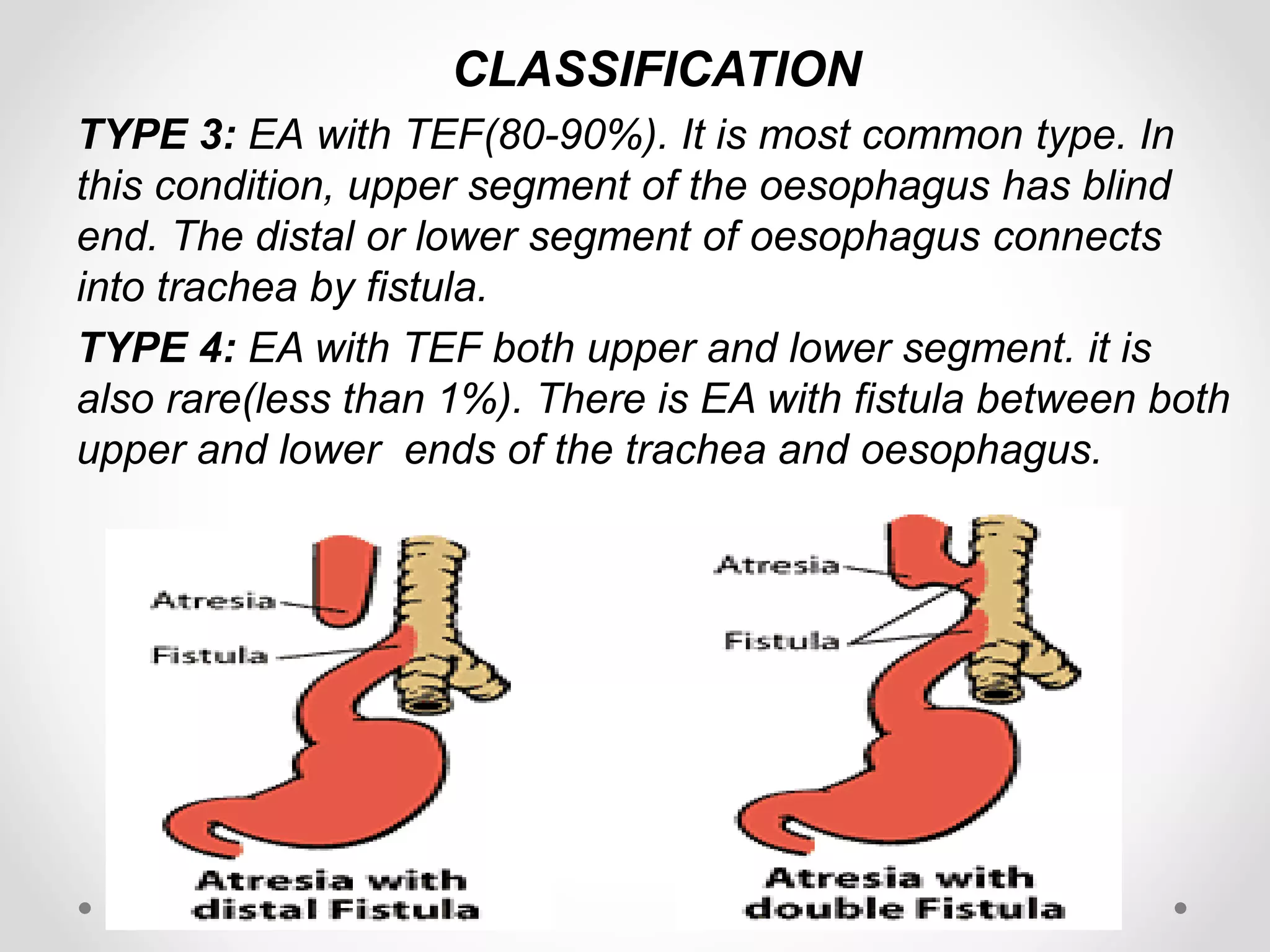 Tracheoesophageal fistula | PPTX