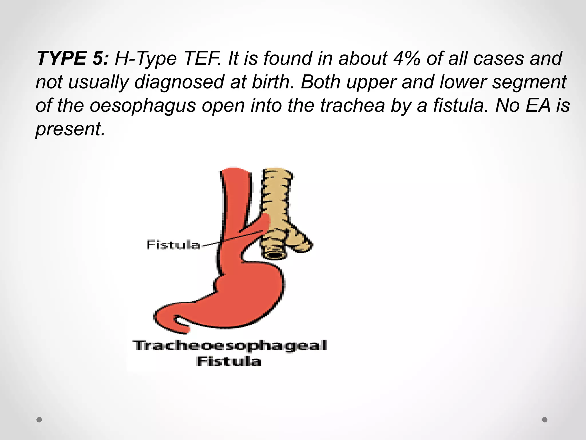 Tracheoesophageal fistula | PPTX