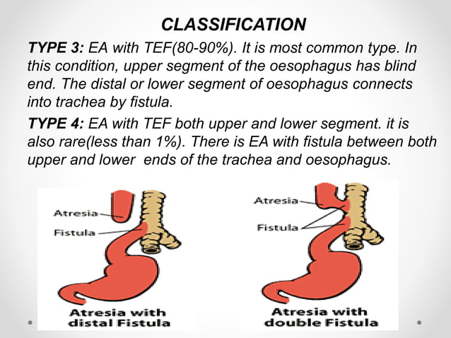 Tracheoesophageal fistula | PPTX | Pregnancy | Reproductive Health