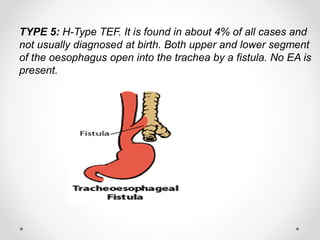 Tracheoesophageal fistula | PPTX