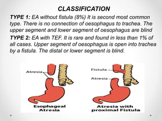 Tracheoesophageal Fistula Classification