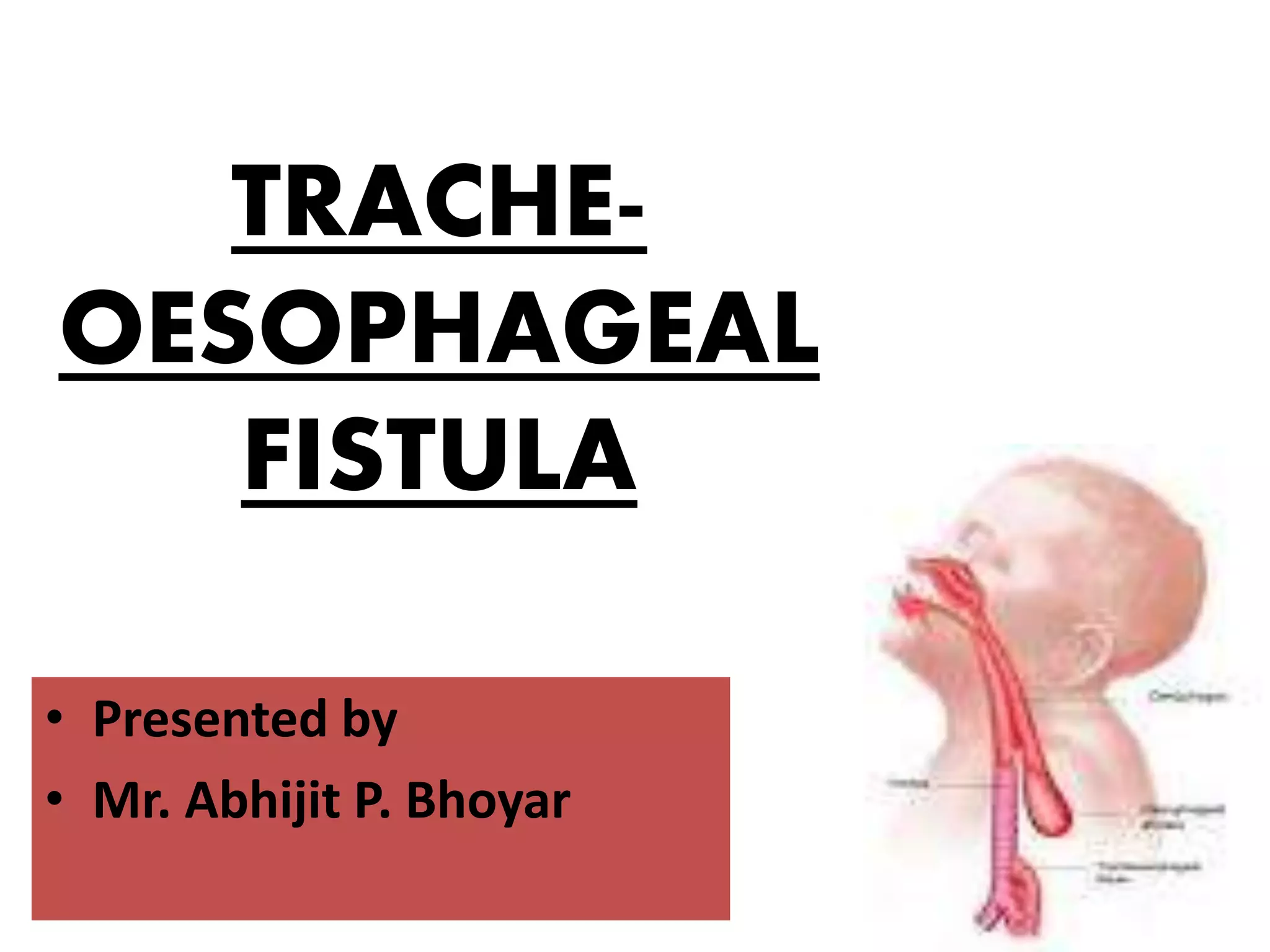 Tracheoesophageal fistula | PPTX