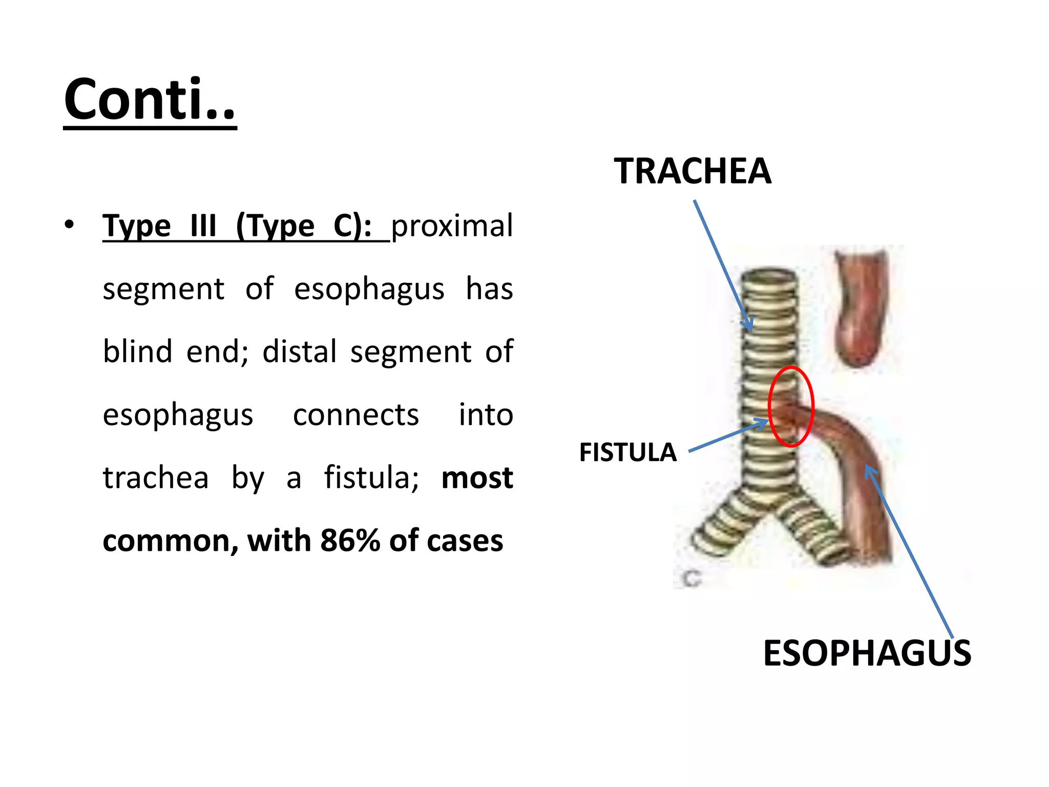 Tracheoesophageal Fistula Ppt