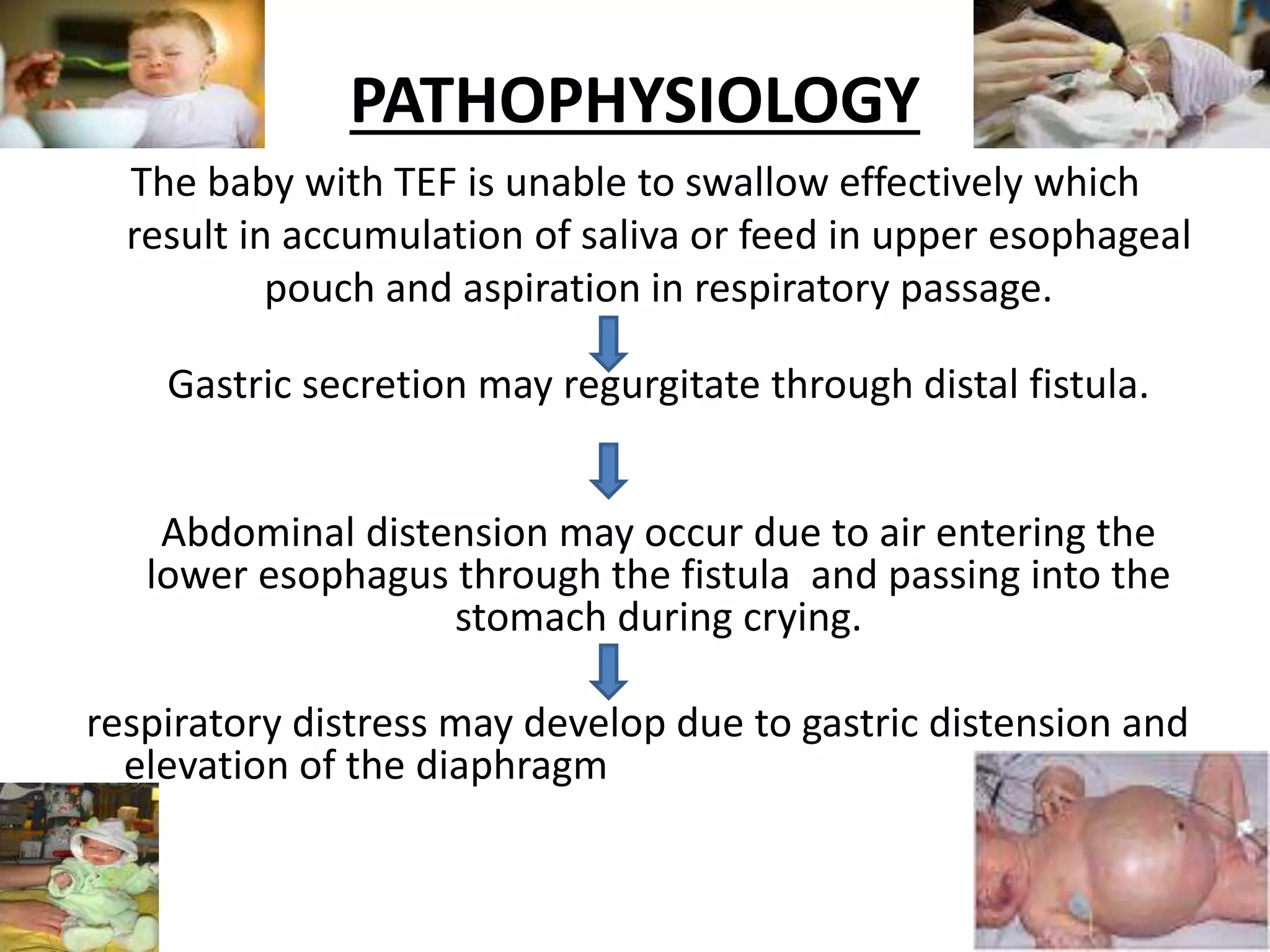 Tracheoesophageal fistula | PPTX