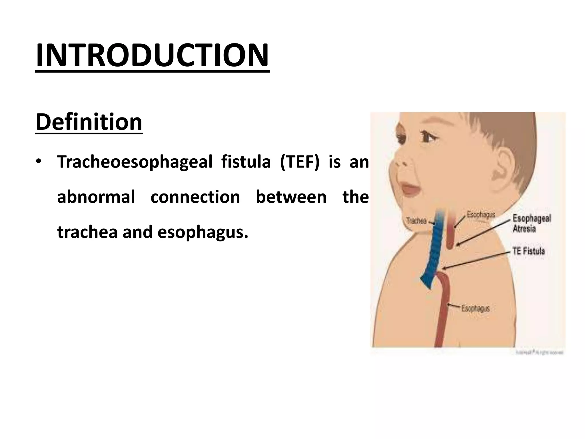 Tracheoesophageal fistula | PPTX