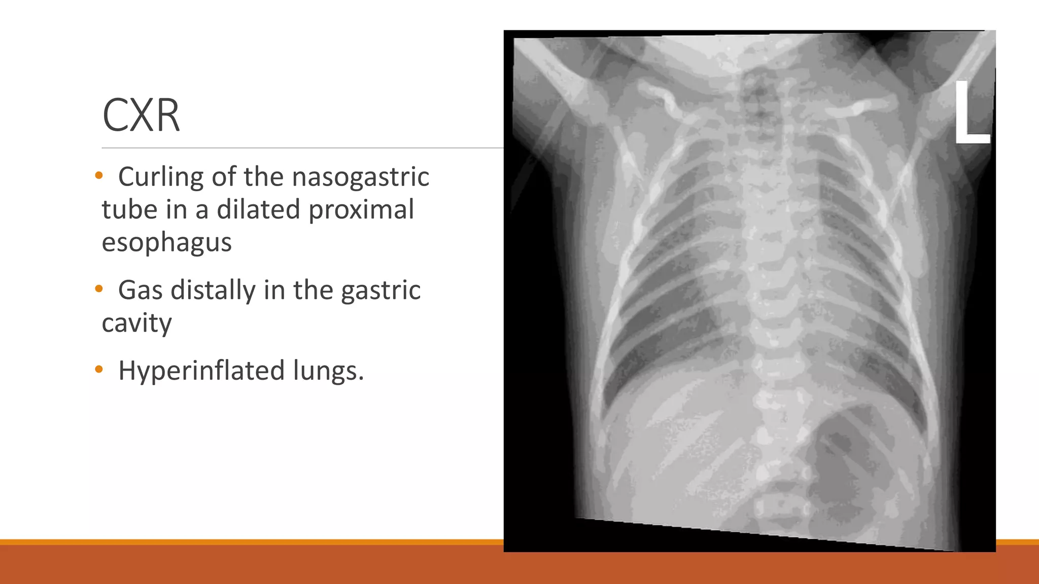 TRACHEO ESOPHAGEAL FISTULA.pptx