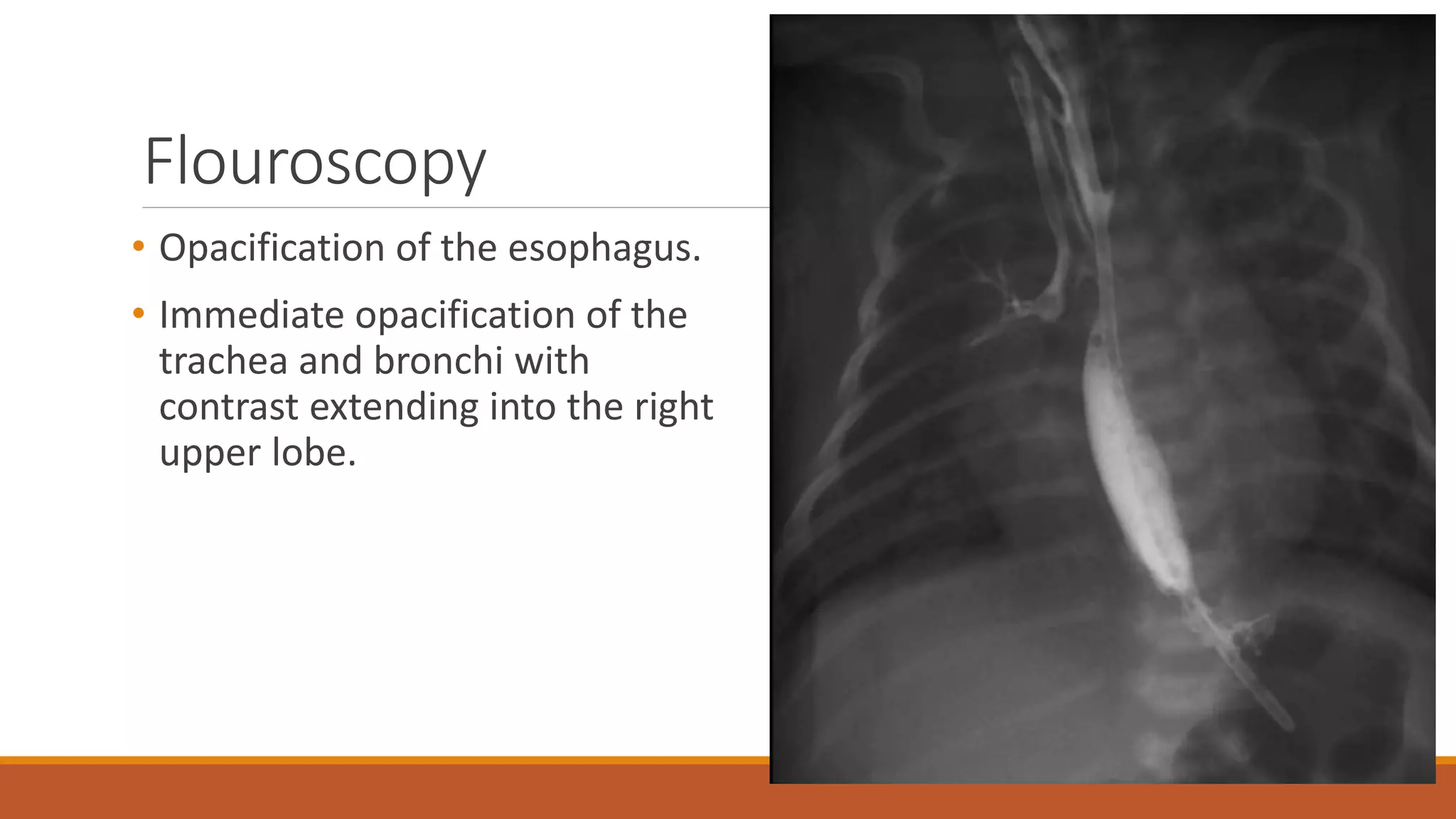 TRACHEO ESOPHAGEAL FISTULA.pptx