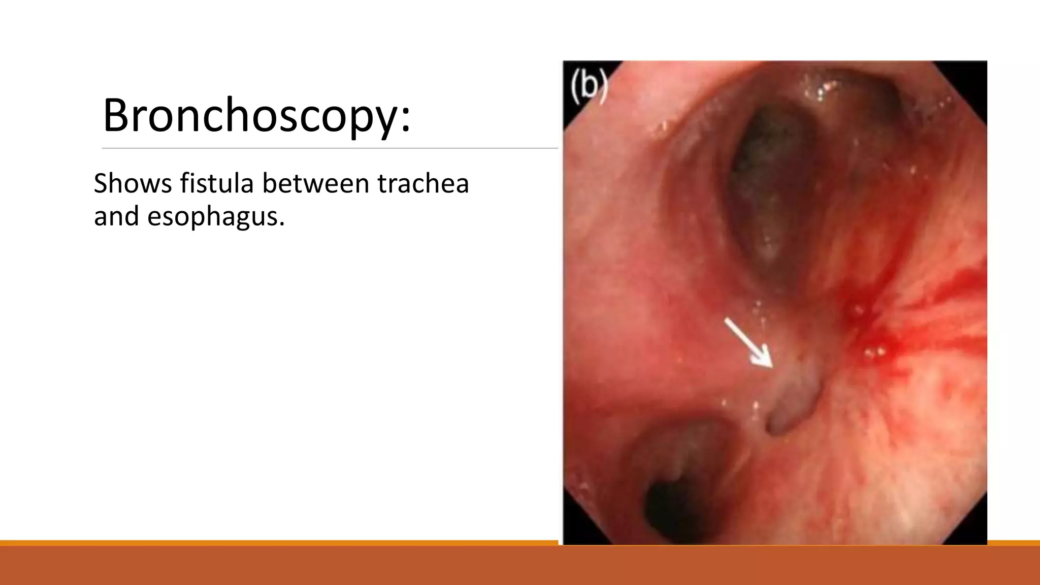 TRACHEO ESOPHAGEAL FISTULA.pptx