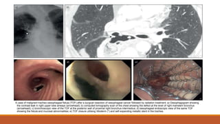 TRACHEO ESOPHAGEAL FISTULA.pptx